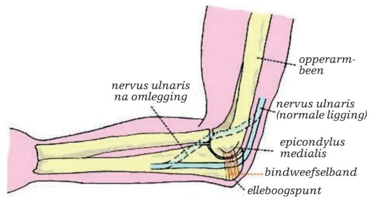 Sulcus nervi ulnaris syndroom - Tergooi MC Sulcus nervi ulnaris syndroom - Tergooi MC