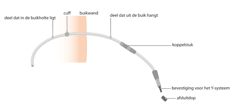 Peritoneale dialysekatheter - Tergooi MC