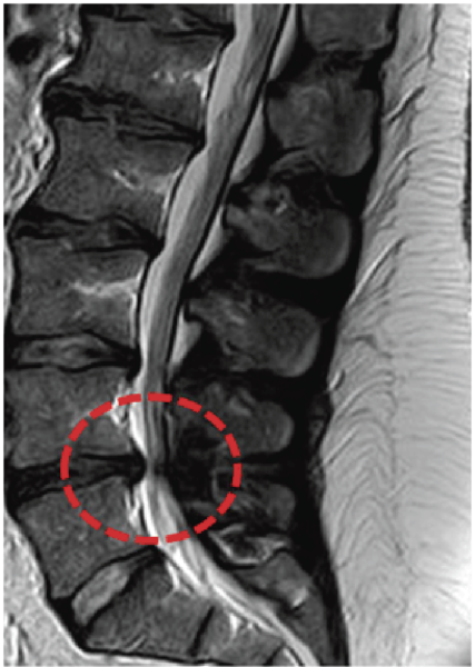 Hernia Operatie lage rug - Tergooi MC