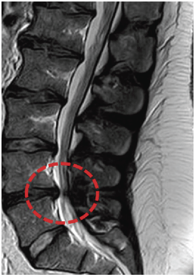 Hernia Operatie lage rug - Tergooi MC