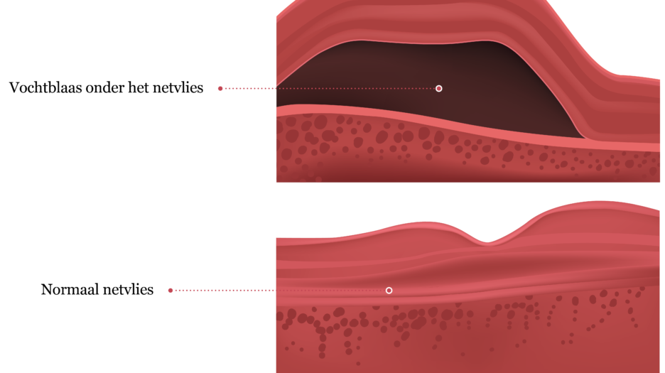 Retinitis centralis serosa (RCS) - Tergooi MC