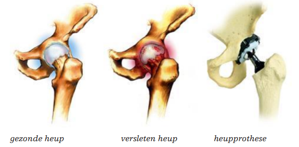 Totale heupprothese - Tergooi MC