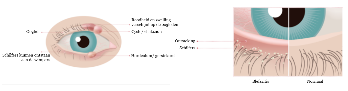 Blefaritis (ooglidrandontsteking) en meibomklierdysfunctie - Tergooi