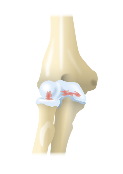 Nieuwe elleboog, elleboogprothese, elleboogartroplastiek - Tergooi MC