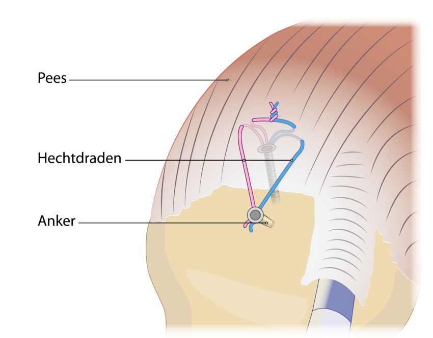 Cuff-ruptuur (peesscheur schouder) - Tergooi MC Cuff-ruptuur (peesscheur schouder) - Tergooi MC