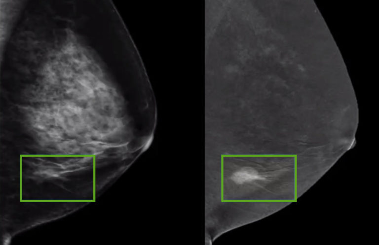 Contrastmammografie: nieuwe onderzoeksmethode bij het opsporen van borstkanker - Tergooi MC